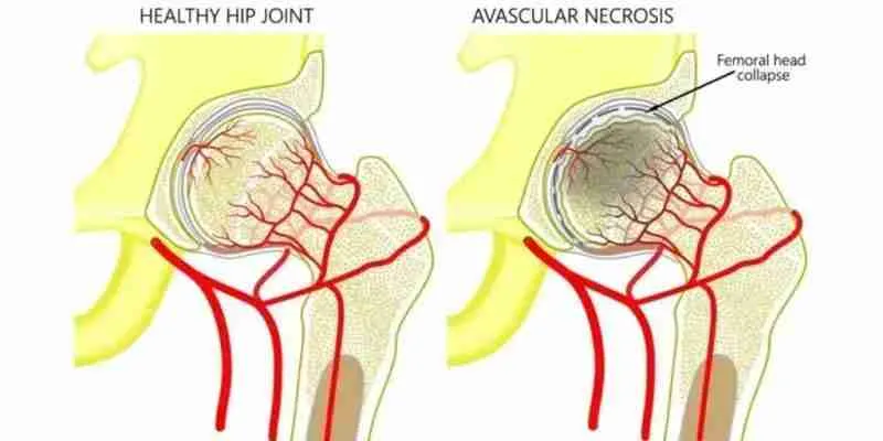 Hip Avascular Necrosis | Preservation & Replacement