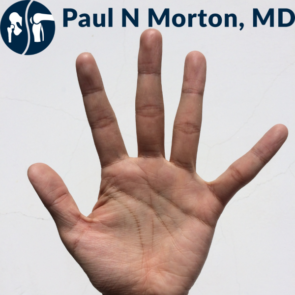 Trigger Finger Surgery In Honolulu, Hawaii - Dr. Paul Norio Morton, MD ...