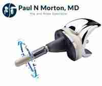 PersonaIQ Is The First Smart Knee Implant: How It Changes Outcomes - Dr ...