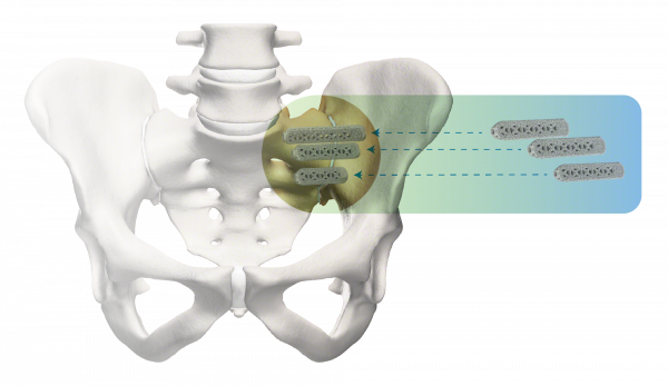 How To Know If You Are A Candidate For SI Joint Fusion - Dr. Paul Norio ...