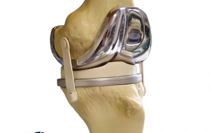 Total Knee Replacement Infection | Orthopedic Surgery