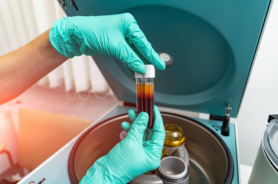 Demystifying PRP Therapy: Understanding The Science Behind Platelet ...