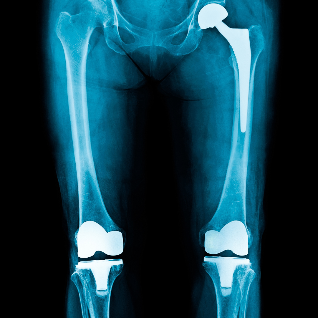 Is Metal Allergy A Concern In Hip And Knee Replacement Surgery? - Dr ...