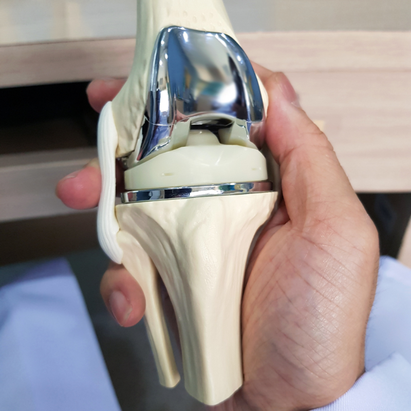 Is Metal Allergy A Concern In Hip And Knee Replacement Surgery? - Dr ...