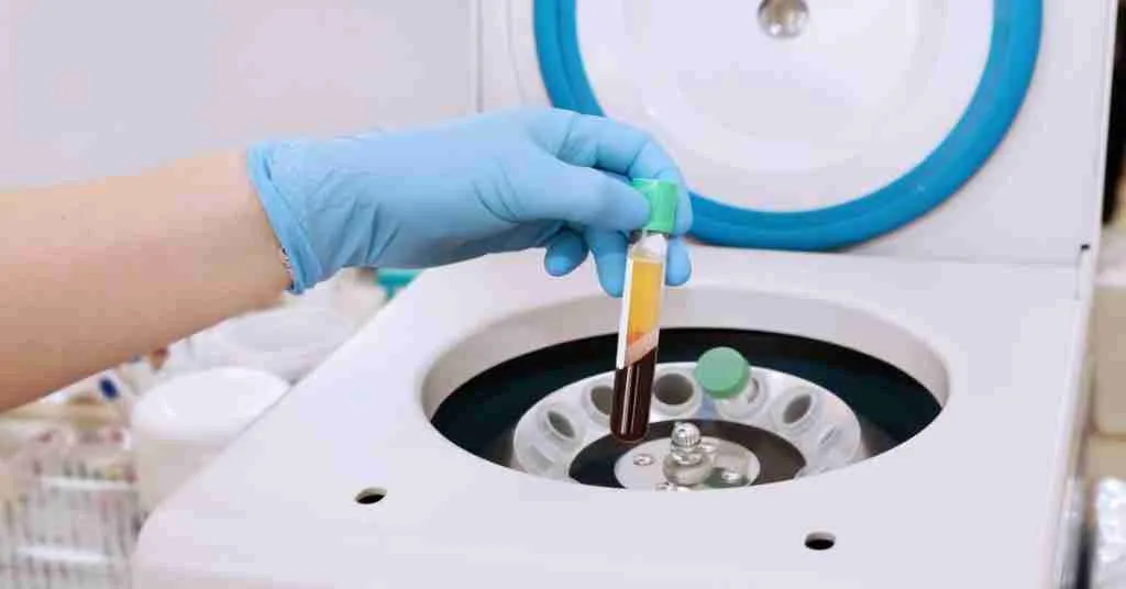 The Role Of PRP In Meniscus Repair Surgery In 2025 - Dr. Paul Norio ...