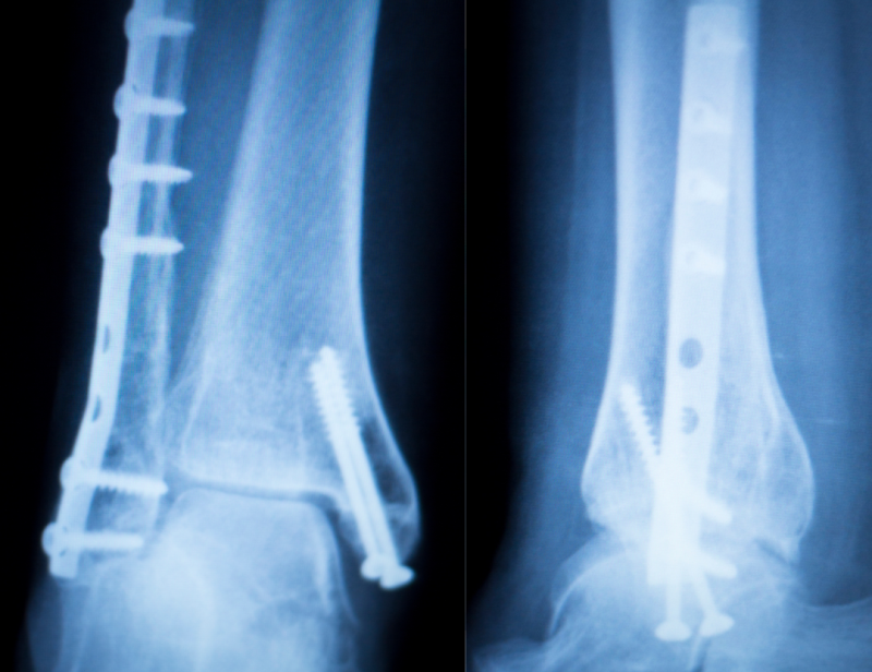 When Is Hardware Removal Necessary In Orthopedic Surgery? - Dr. Paul ...